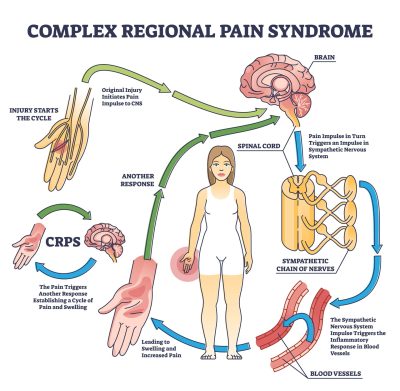 CRPS Life Expectancy & Prognosis Explained